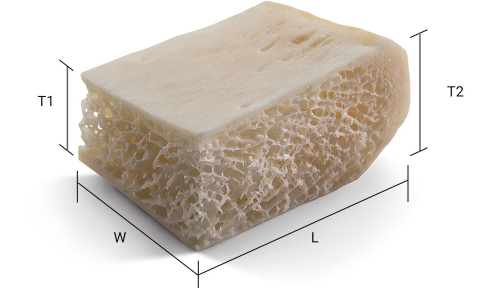 Tri-cortical Block (Iliac Crest Wedge) - Maxxeus